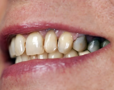 Causes of Tooth Decay - Fox Dental Associates | Fox Dental Associates